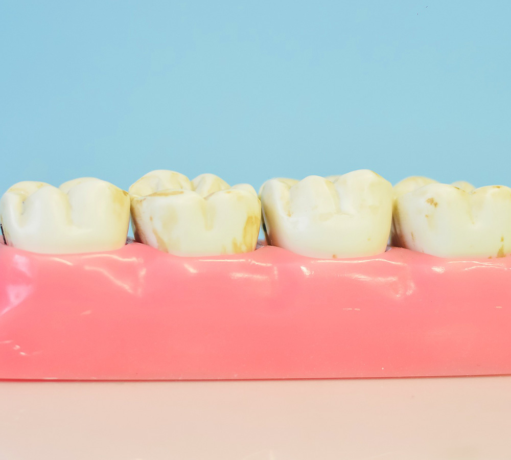 Qu’est-ce que la récession gingivale? - Retter Dental Care